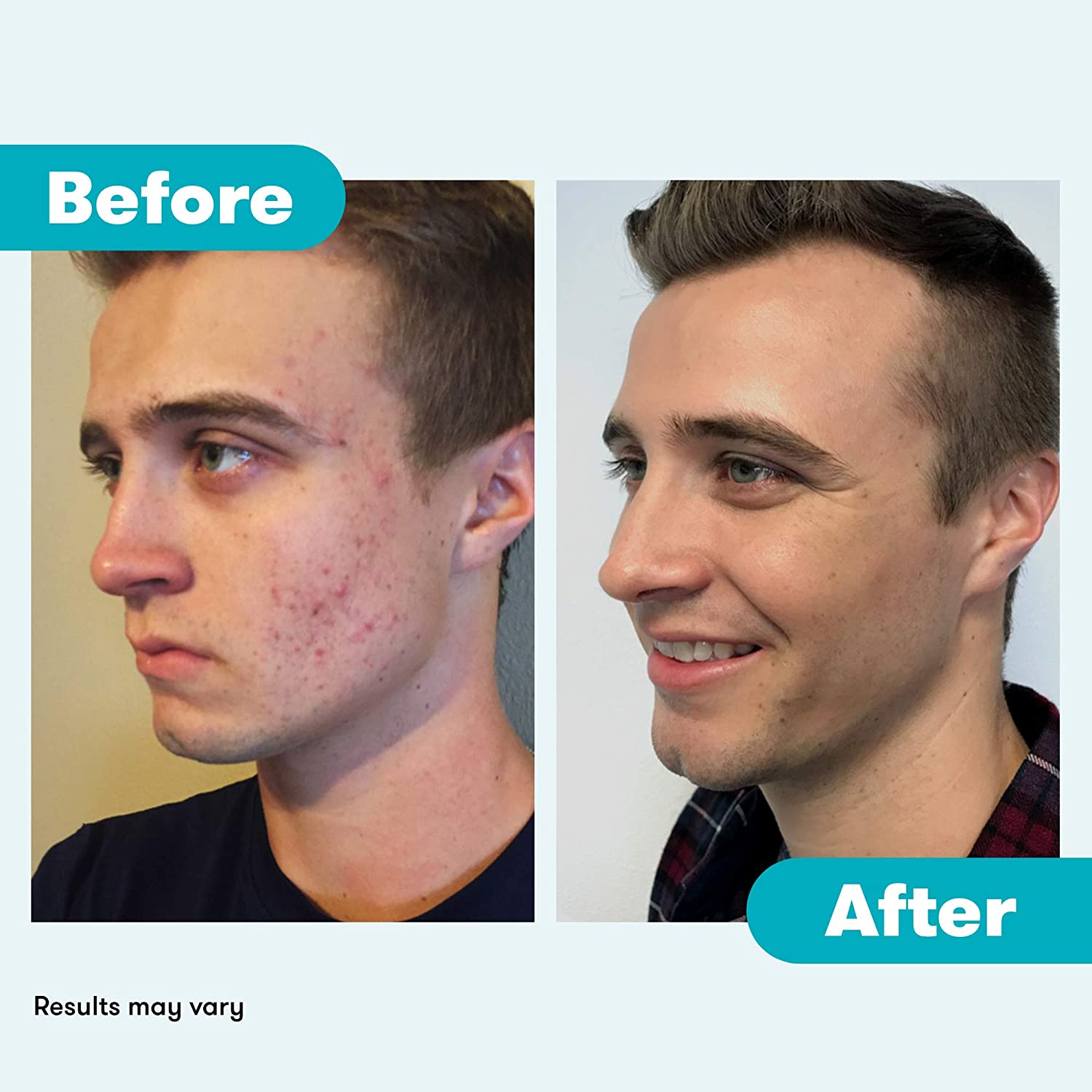 Comparing Proactiv MD vs Differin for Acne Treatment – Seeking Derma